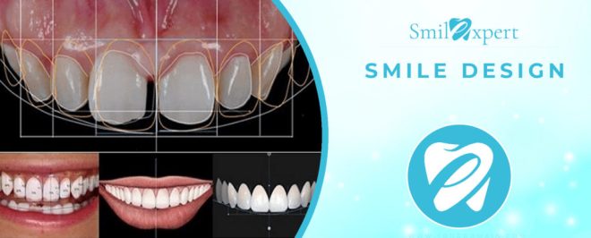Smile Design in Budapest | Personalized Cosmetic Dentistry at Smile Expert